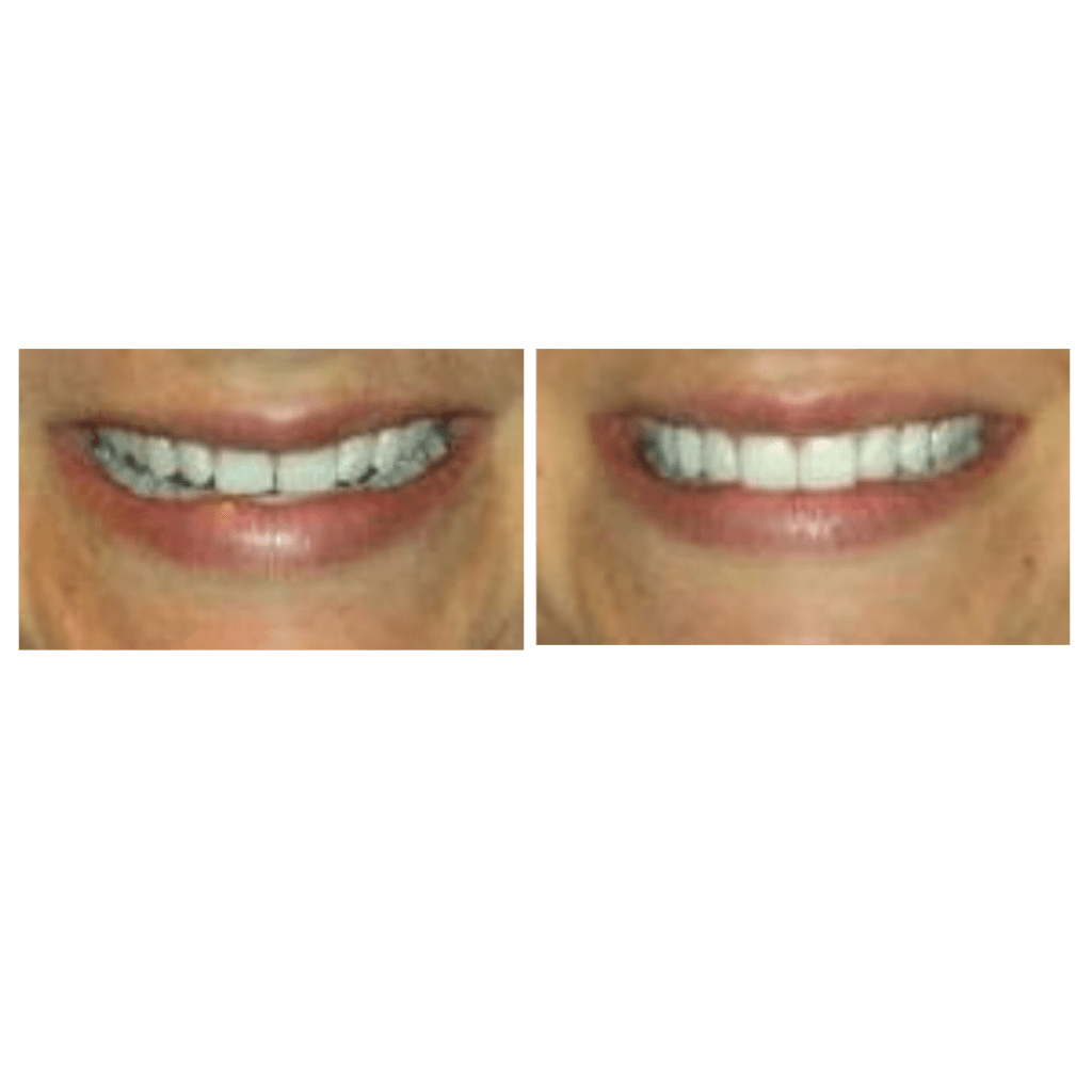 Featured Smile of the Week With Dental Porcelain Veneers | MOD Squad Dental