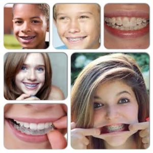MOD Squad Dental-Braces-When? What? Why? | MOD Squad Dental