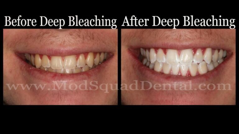 KOR Deep Bleaching - The Number 1 Teeth Whitening Procedure Recommended ...